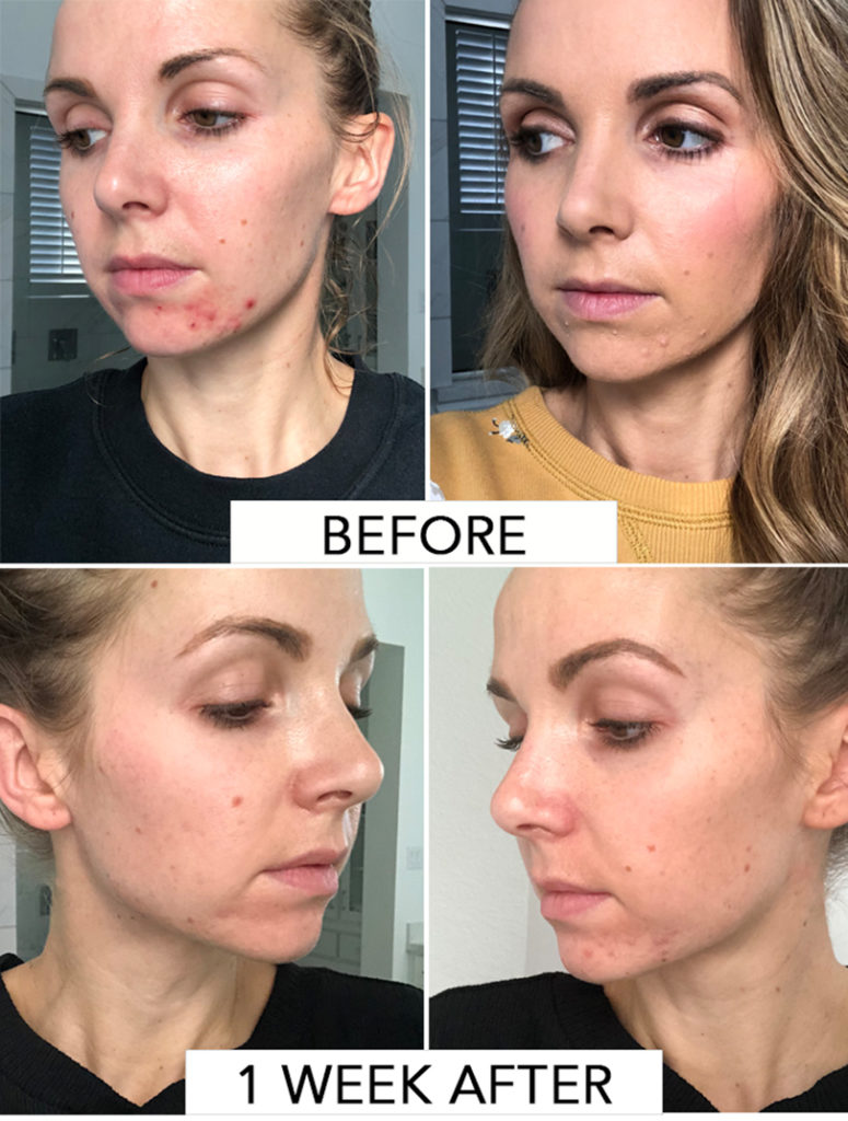 My Skin Care Routine for Acne Prone Skin [Updated] - Merrick's Art